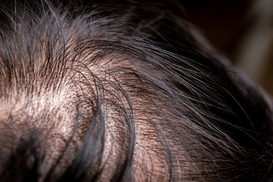 Cómo saber si la raíz del pelo está muerta - Instituto Quirúrgico ...